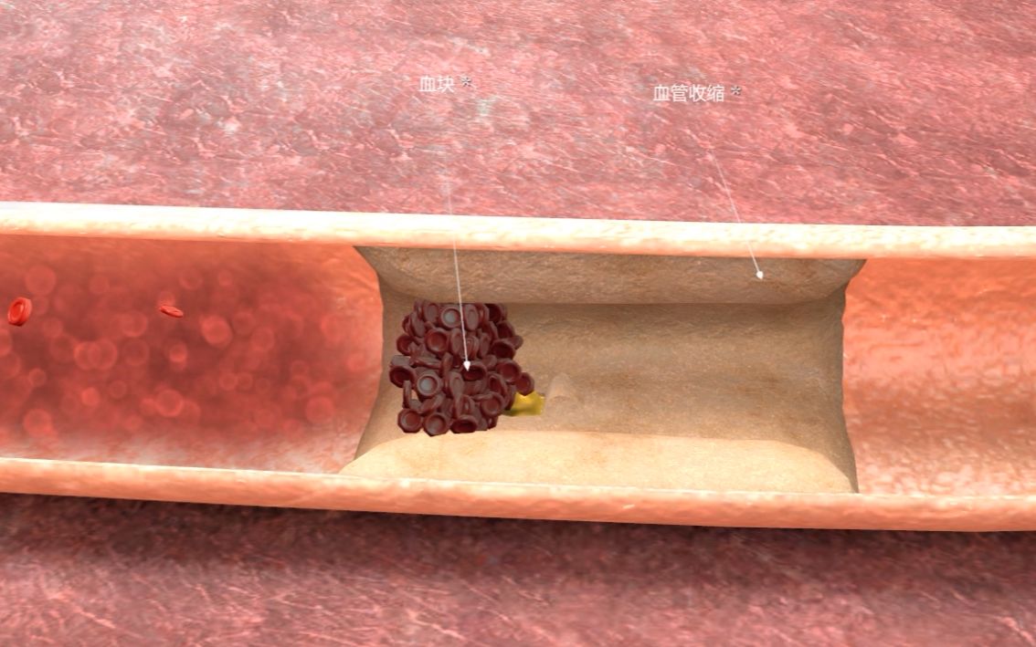 “血栓”它像塞子一样堵塞了身体各部位血管的通道,一旦堵塞血管,会...