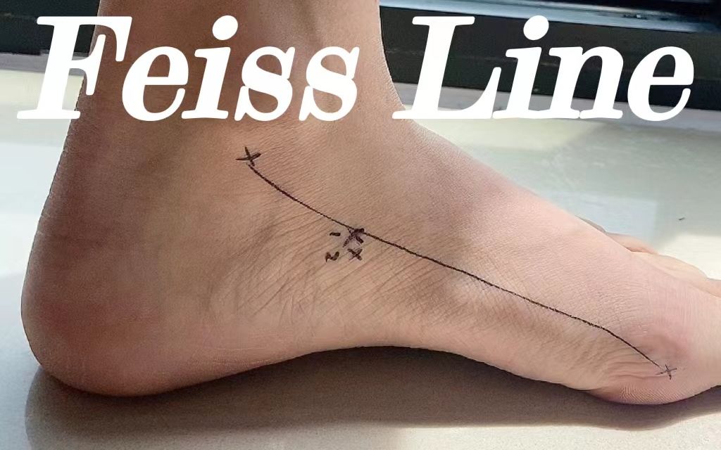 1分钟识别结构性/功能性扁平足:Feiss Line(需要笔和尺)