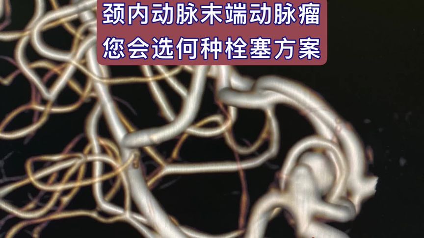 无奖竞答——颈内动脉末端动脉瘤,不考虑经济情况