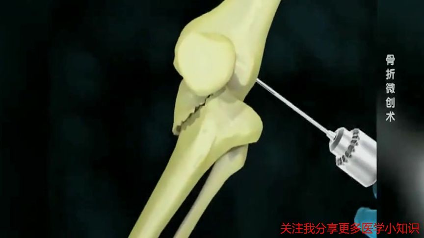 骨折微创手术的动画全过程,中国的医学技术迟早世界第一!