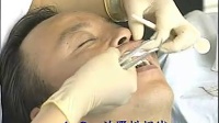 口腔医学视频-固定修复取模_标清
