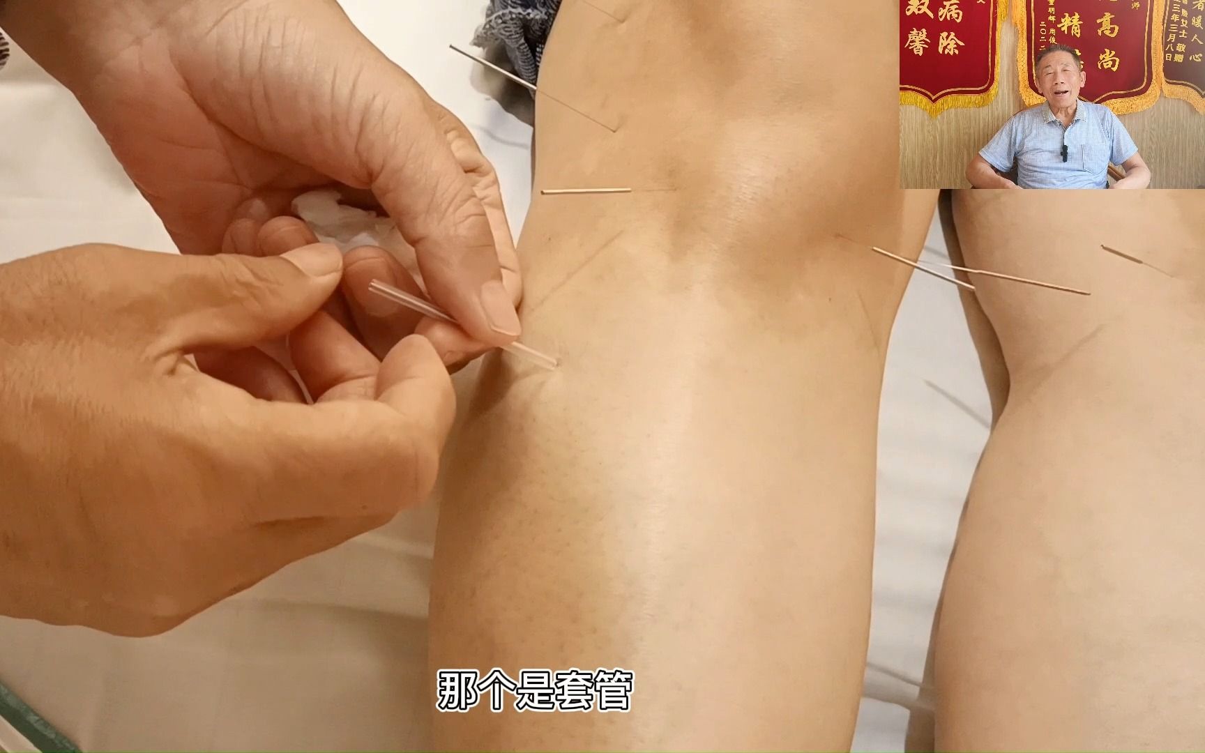 针灸下针用套管的作用是什么?手法是什么样的?