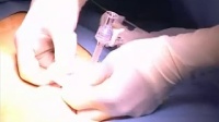手术扩张器(牵开器)使用方法视频