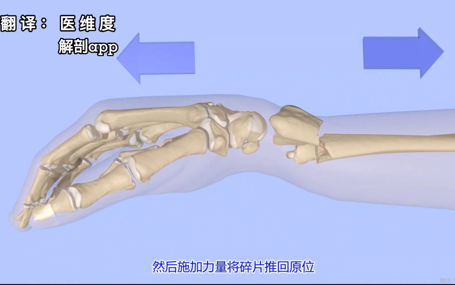 手腕处桡骨远端骨折复位，隔着屏幕感觉到了疼痛！