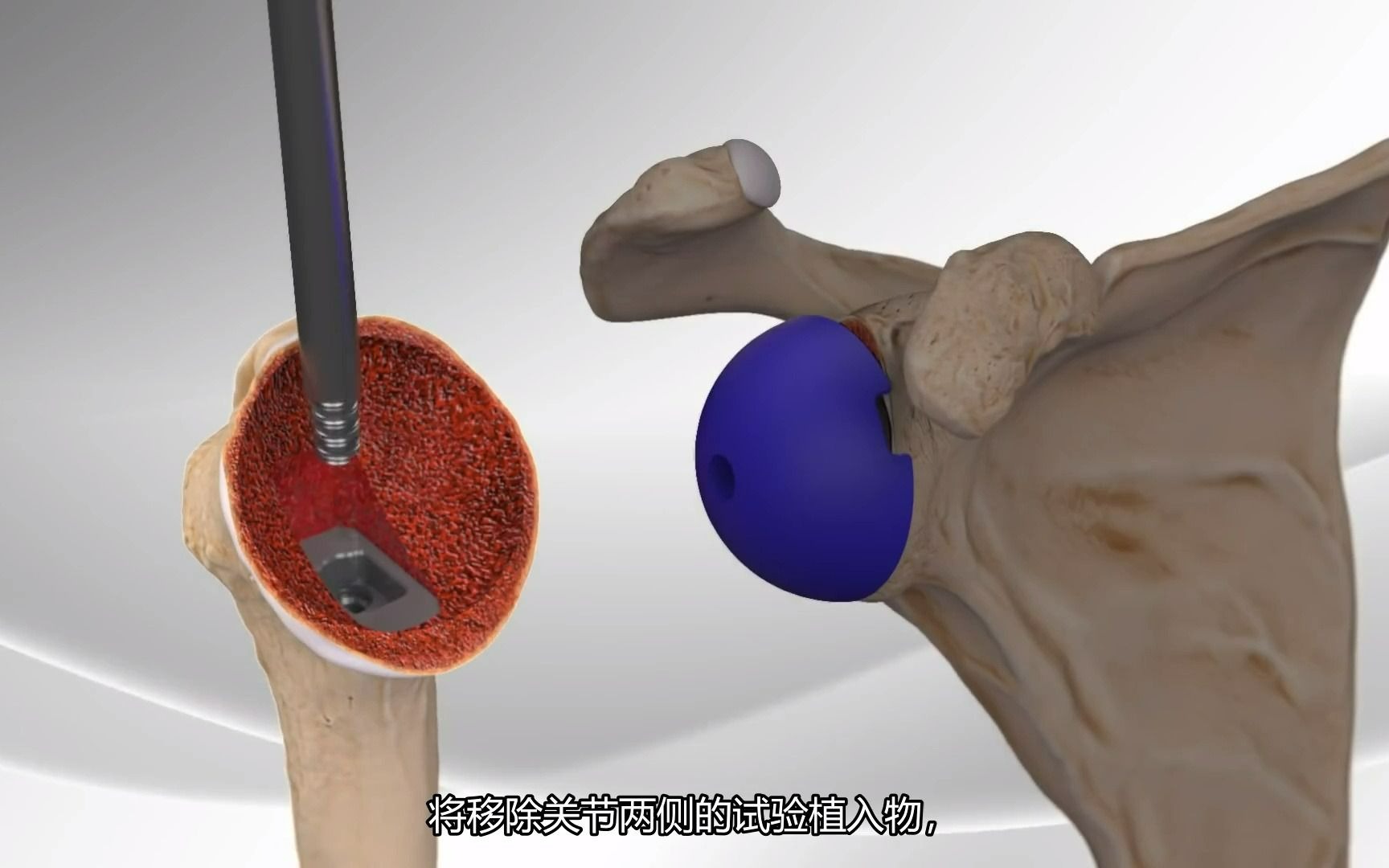 肩关节置换手术