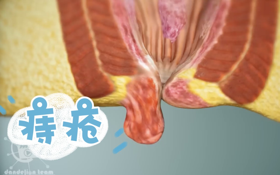有“痔“青年|快来对症下药(痔疮的类型、原因、诊断和治疗)