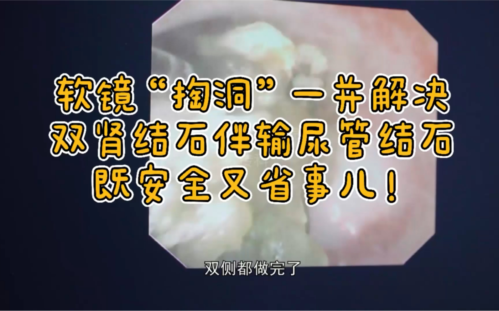 输尿管软镜+钬激光手术解决双肾、输尿管结石 苏州苏城王永新