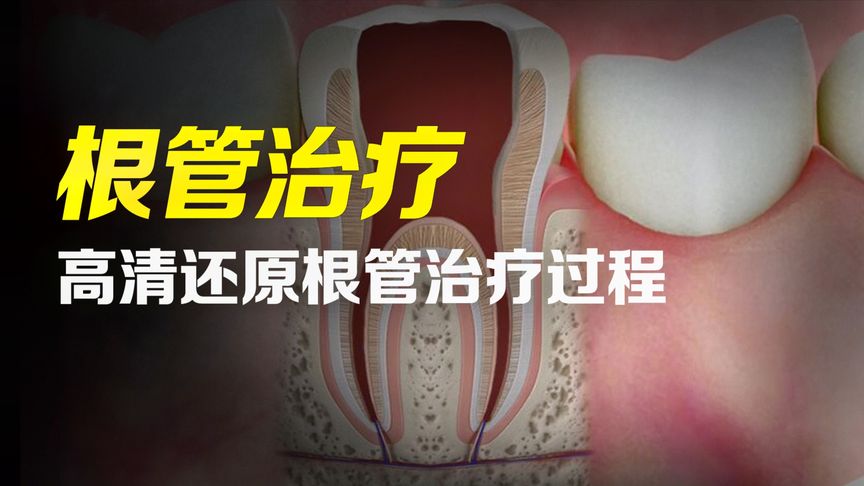3D展示为什么牙齿要做根管?根管治疗的全流程