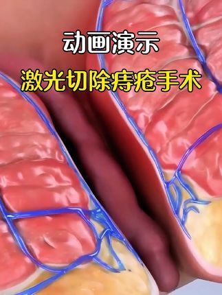 3D动画演示,激光切除痔疮手术