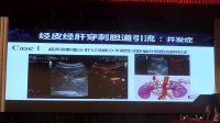 5.经皮经肝穿刺胆道引流:操作步骤