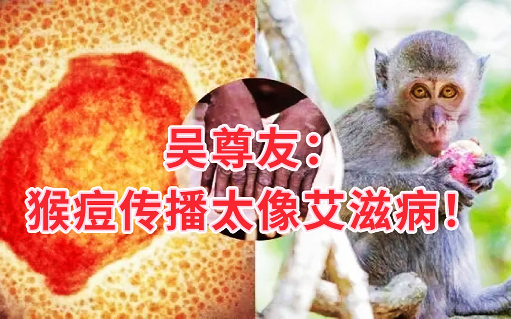 中疾控首席专家再次发声:猴痘虽不是性病,但传播太像艾滋病