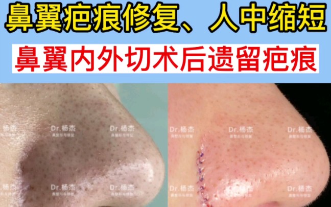 鼻翼疤痕修复,完整切除疤痕组织