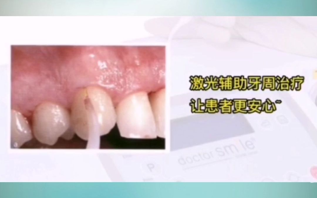 激光诊疗之牙周模式
