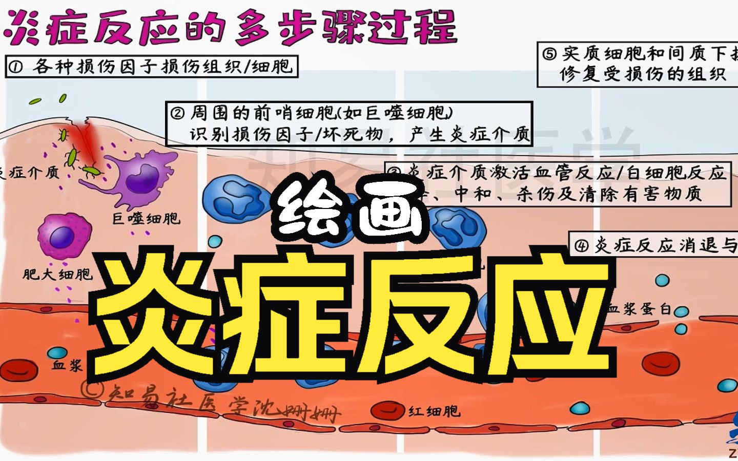 【绘画 病理学 炎症】3分钟掌握 病理学炎症反应的过程