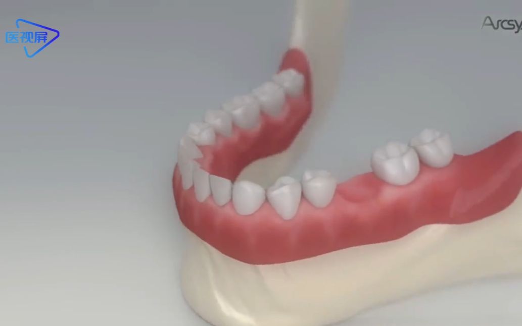 【医学3D】:种植牙的全过程,一看就懂