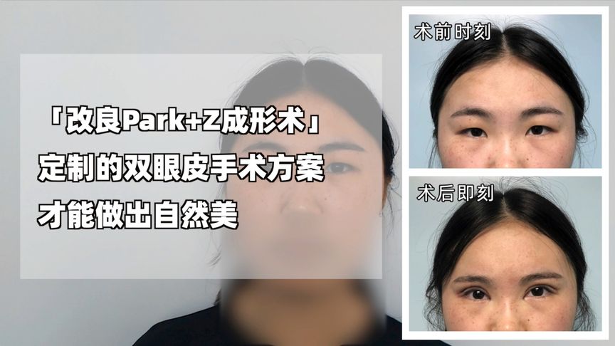 「改良park+Z成形术」定制的双眼皮手术方案,才能做出自然美