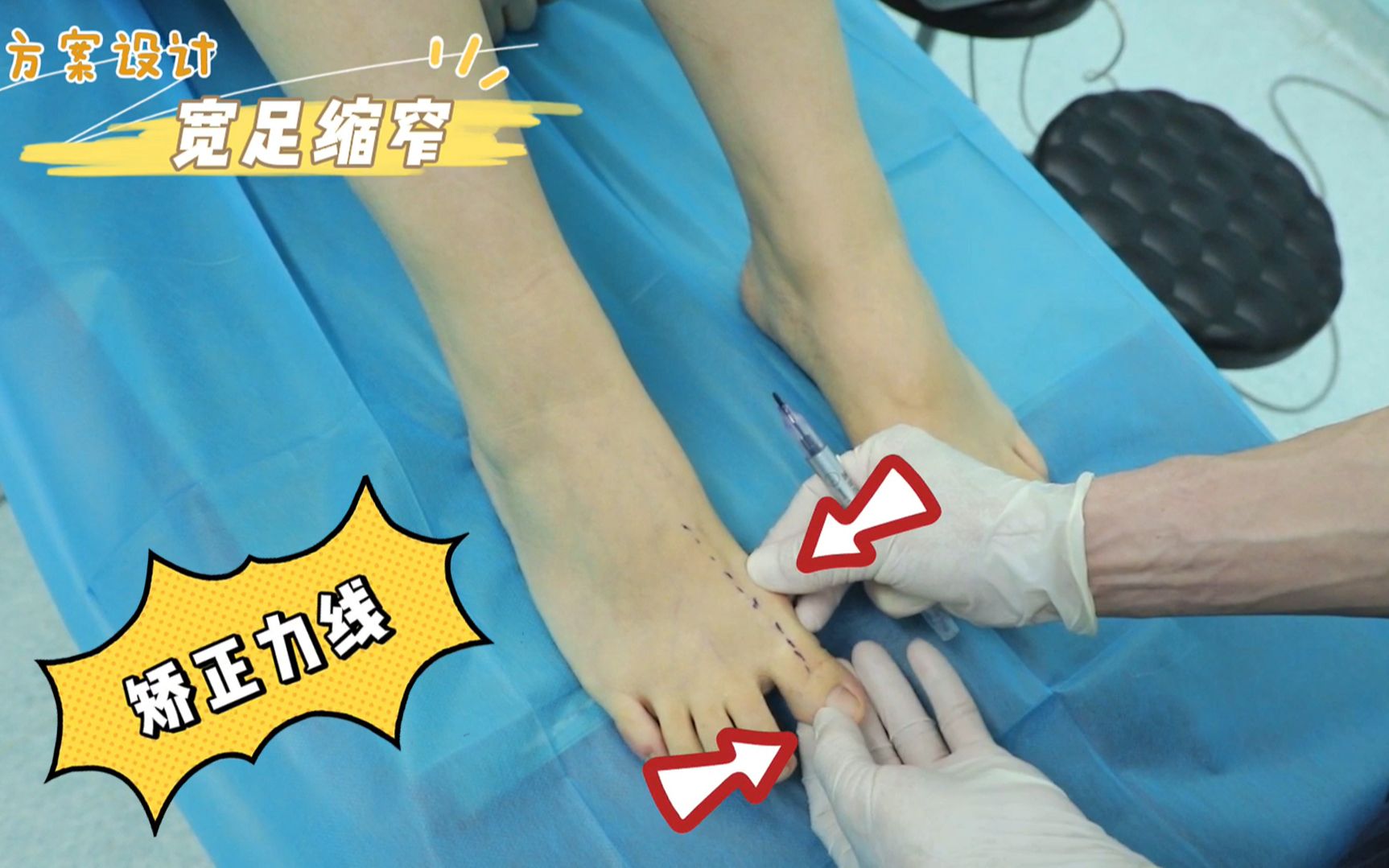 【苏敬达】“丑脚丫”改造:拇外翻+大宽脚+骨突严重,穿鞋不好看!