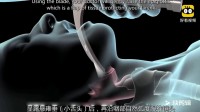 3D动画演示气管插管