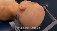 3D动画演示脑瘤摘除手术,真的是病人另一次新生,为先进医学点赞