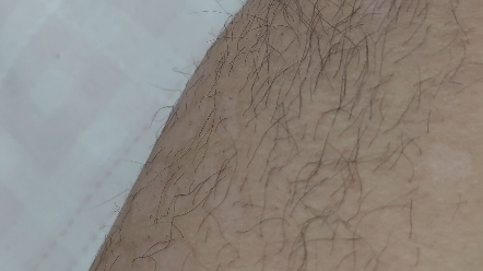 《记录》第六次打针,每个月一次长期针。
