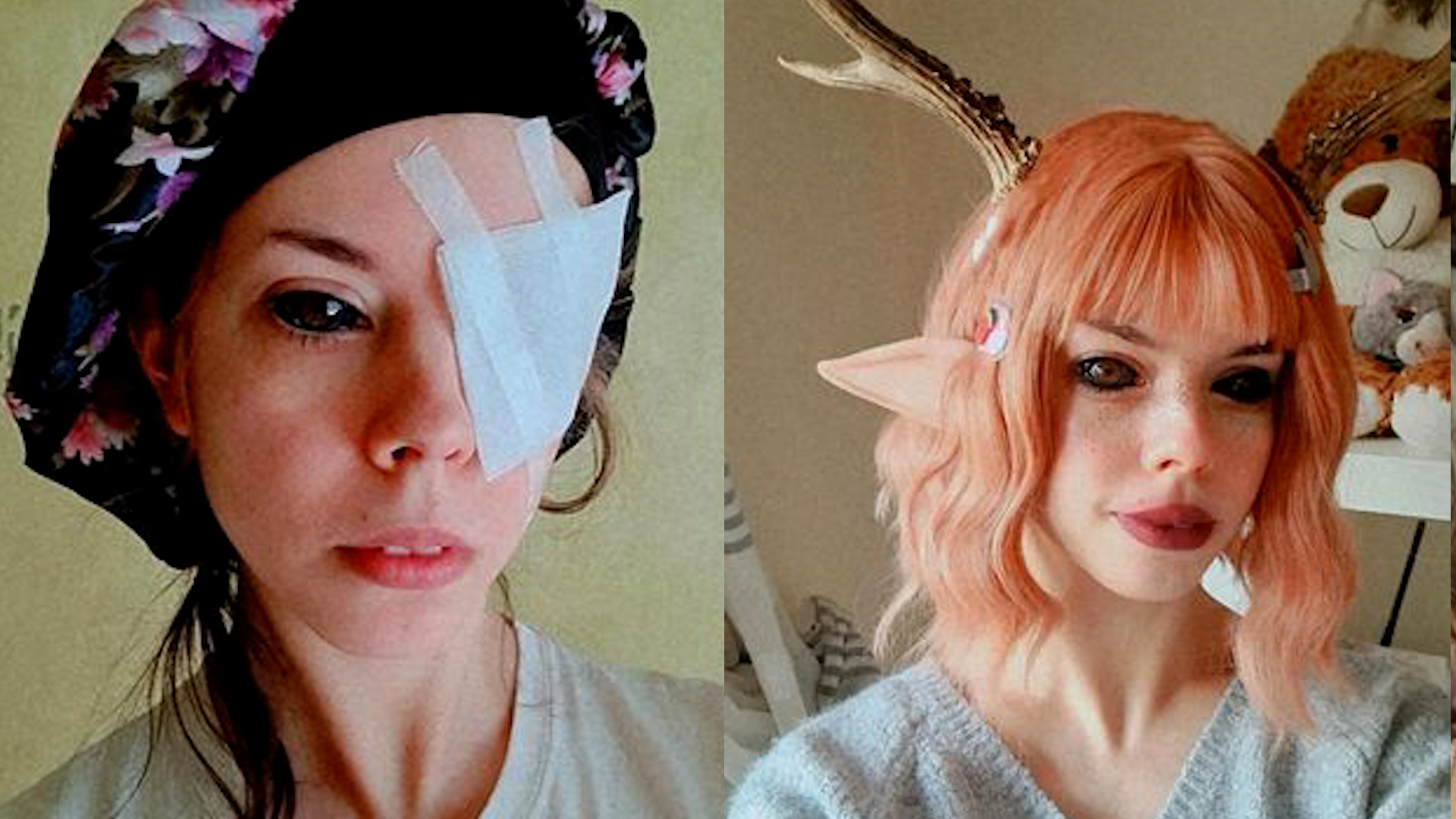 女子效仿明星将眼白纹黑结果失败,崩溃求医却只能悲剧摘除眼球