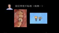 种植体上部结构(牙冠)修复设计的(技师)制作要求.mp4