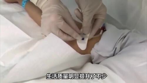 化疗家属必看:PICC导管维护全攻略,让患者少受罪