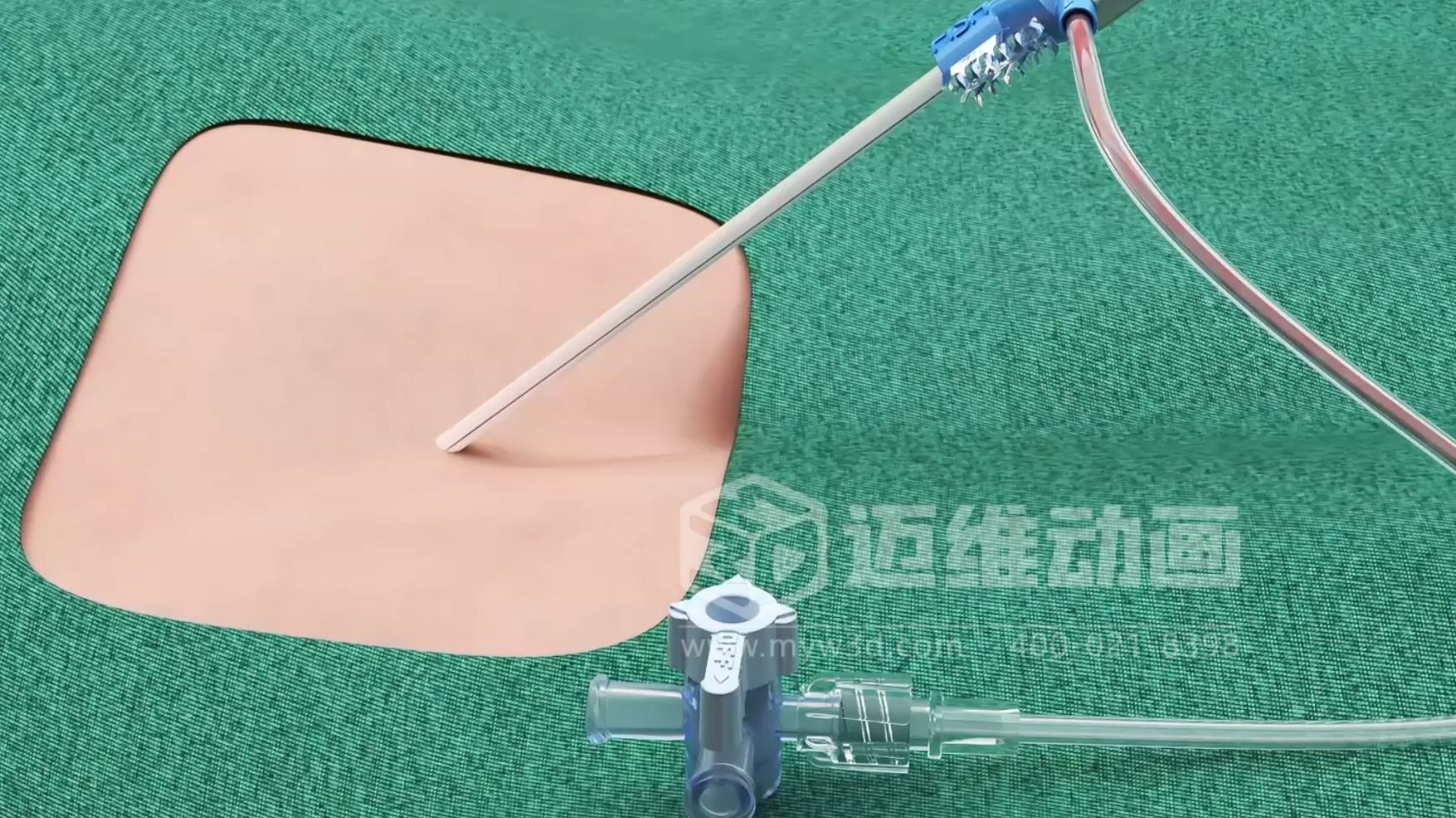 导管鞘封堵修复-医疗器械-医学展示三维动画-迈维动漫制作