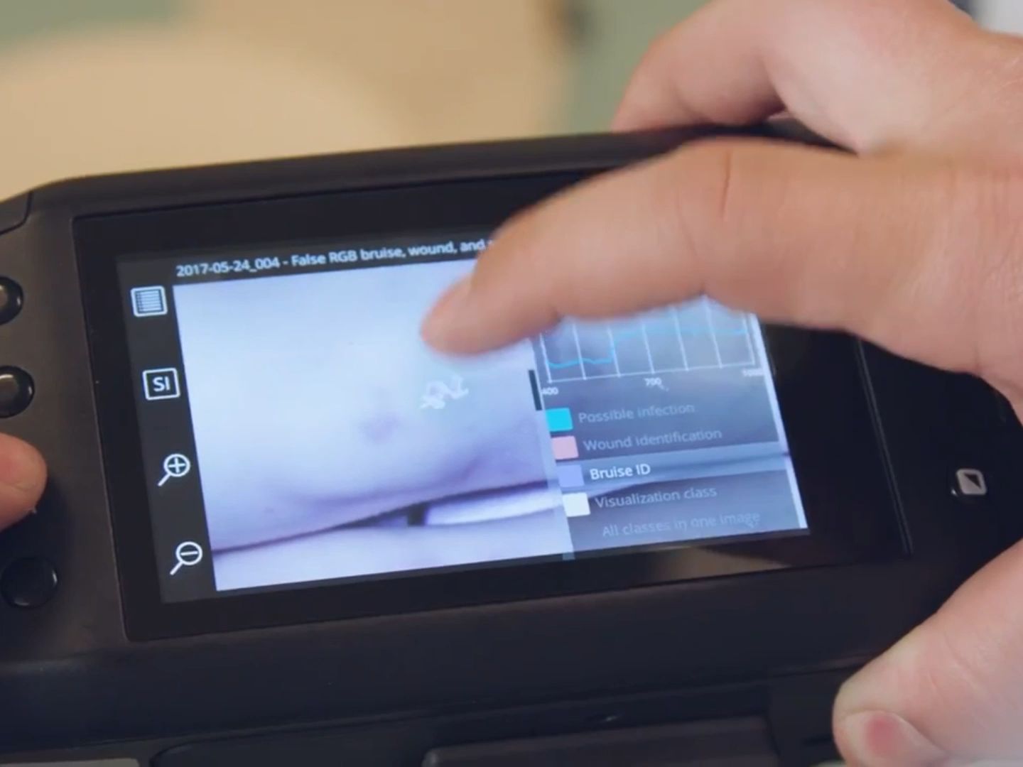 Specim IQ皮肤癌识别