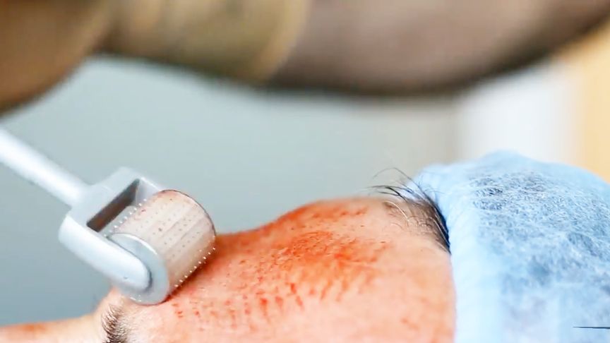 微针正确的无菌操作过程,这可能是医院和美容院的区别之一