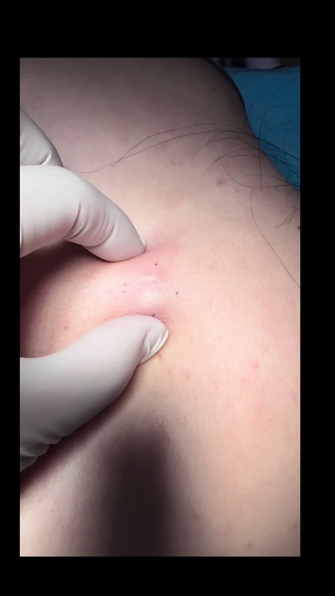 皮脂腺囊肿切开后复发 #皮脂腺囊肿 #皮下囊肿 #表皮囊肿 #脓肿 #痘痘