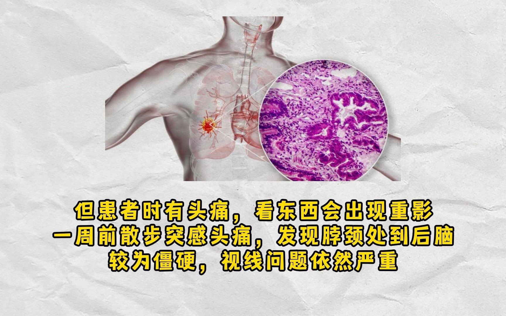 传统医学调治肺腺癌、后脑硬、头痛问题这样解决!