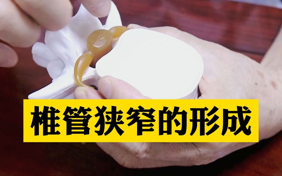 椎管狭窄的形成?