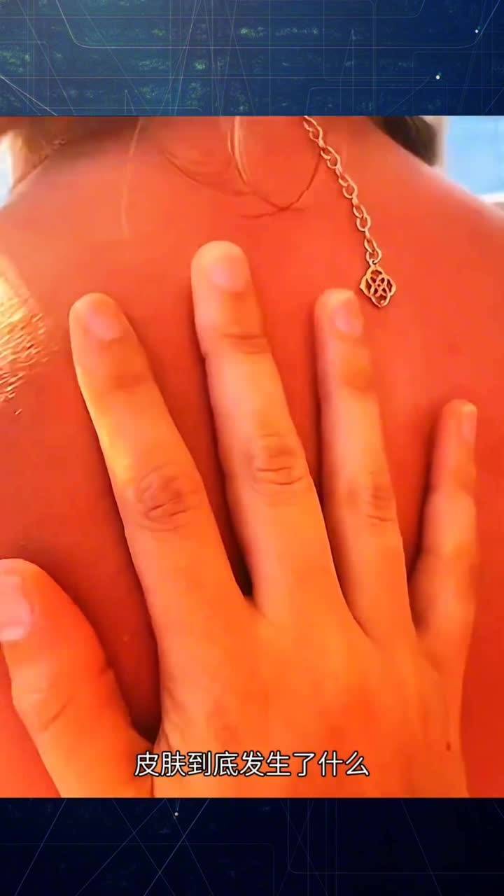 晒伤的时候皮肤发生了什么#动画科普