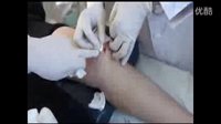 义学青海水针刀培训班-关于膝关节针刀治疗法