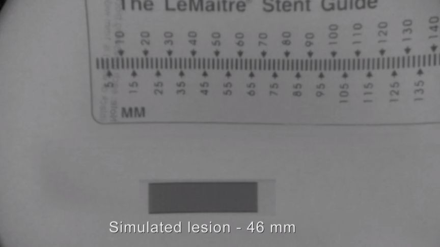 Wallstent静脉支架释放