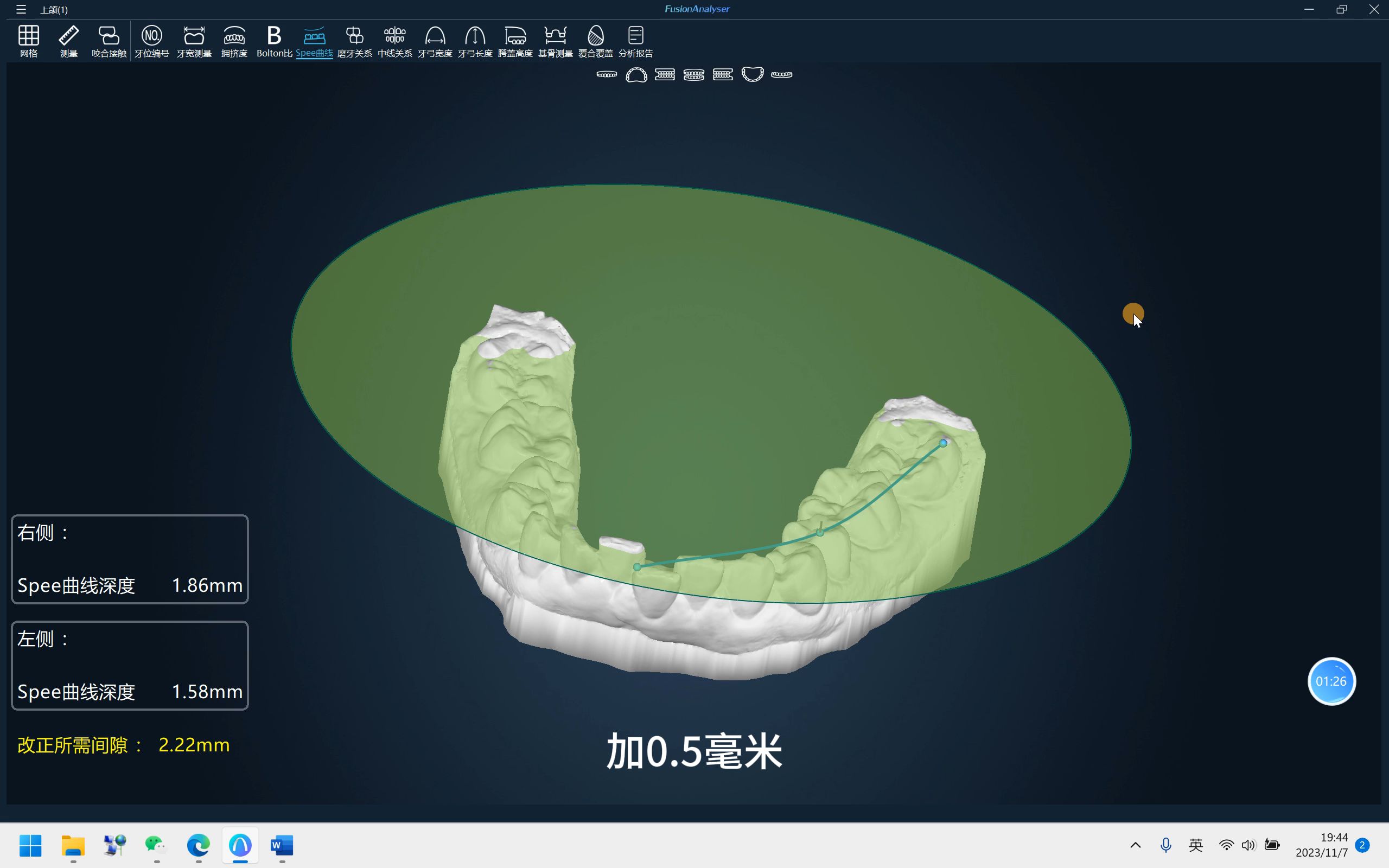 正畸FusionAnalyser模型分析软件(3) 磨牙中线关系 牙弓长度宽度 覆合...