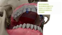 士卓曼种植体全口无牙颌种植流程介绍