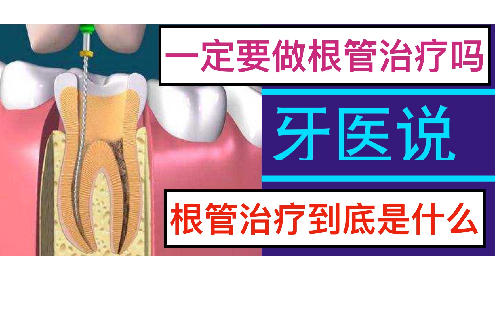 【牙医说】根管治疗是什么,一定要做吗?