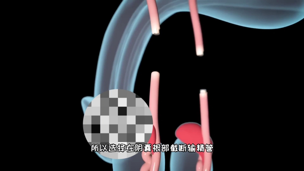 男性输精管结扎绝育手术过程,3D演示。