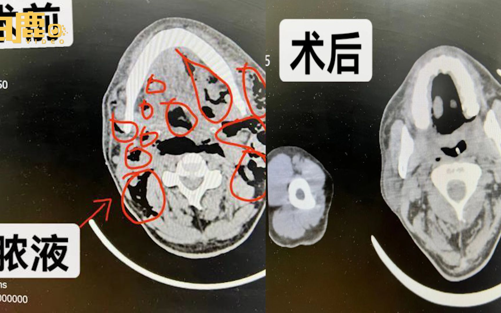 男子拔牙后出现感染4次手术保命,医生:拔牙前后要注意口腔卫生