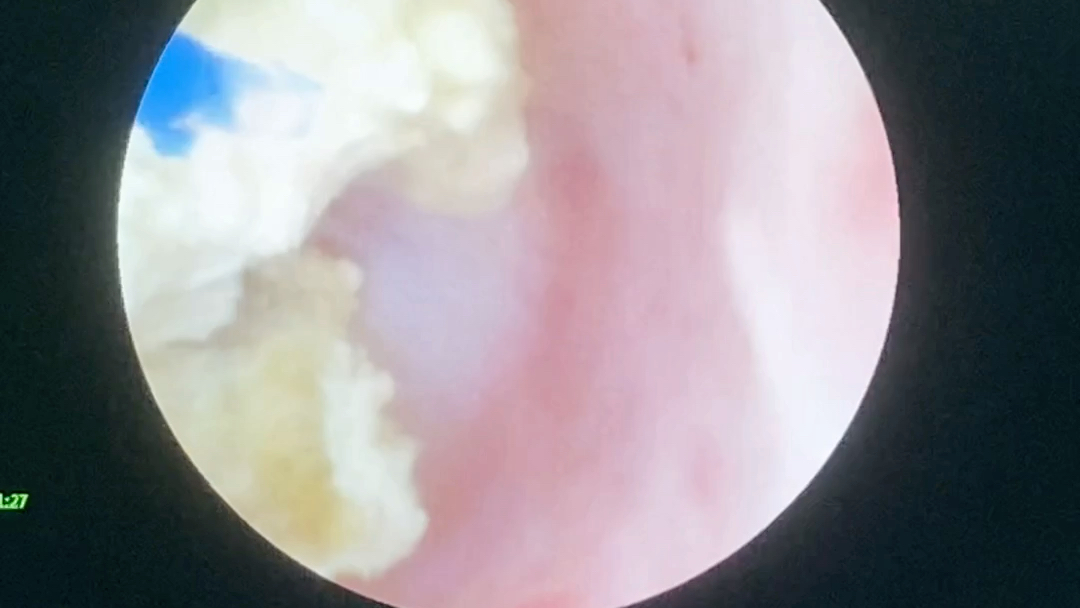 输尿管镜下激光碎石术