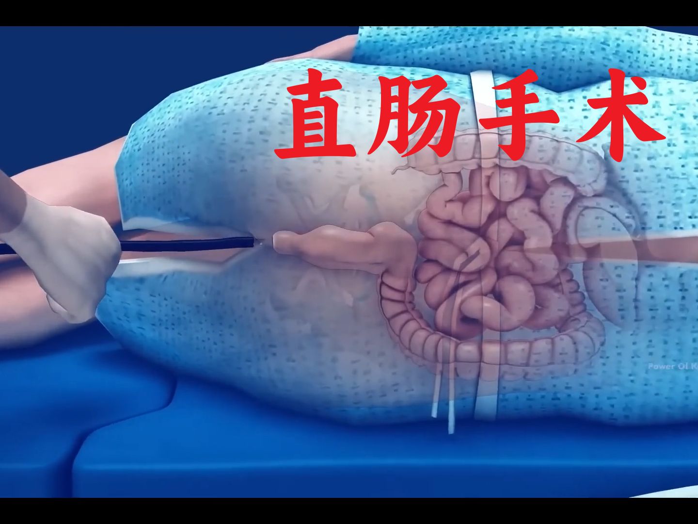 直肠息肉切除手术【医学科普】