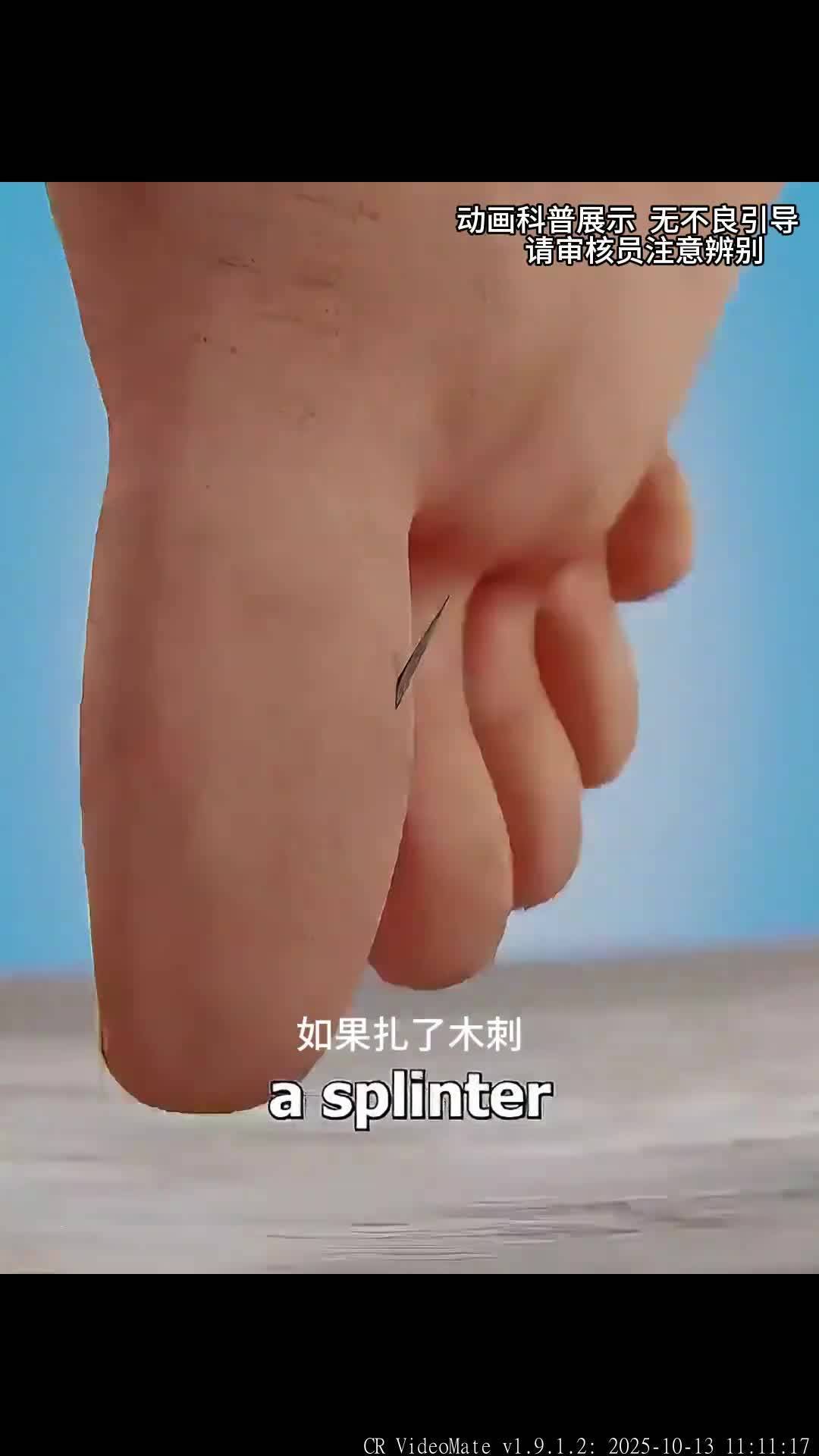 别再硬挑木刺,注射器更好用