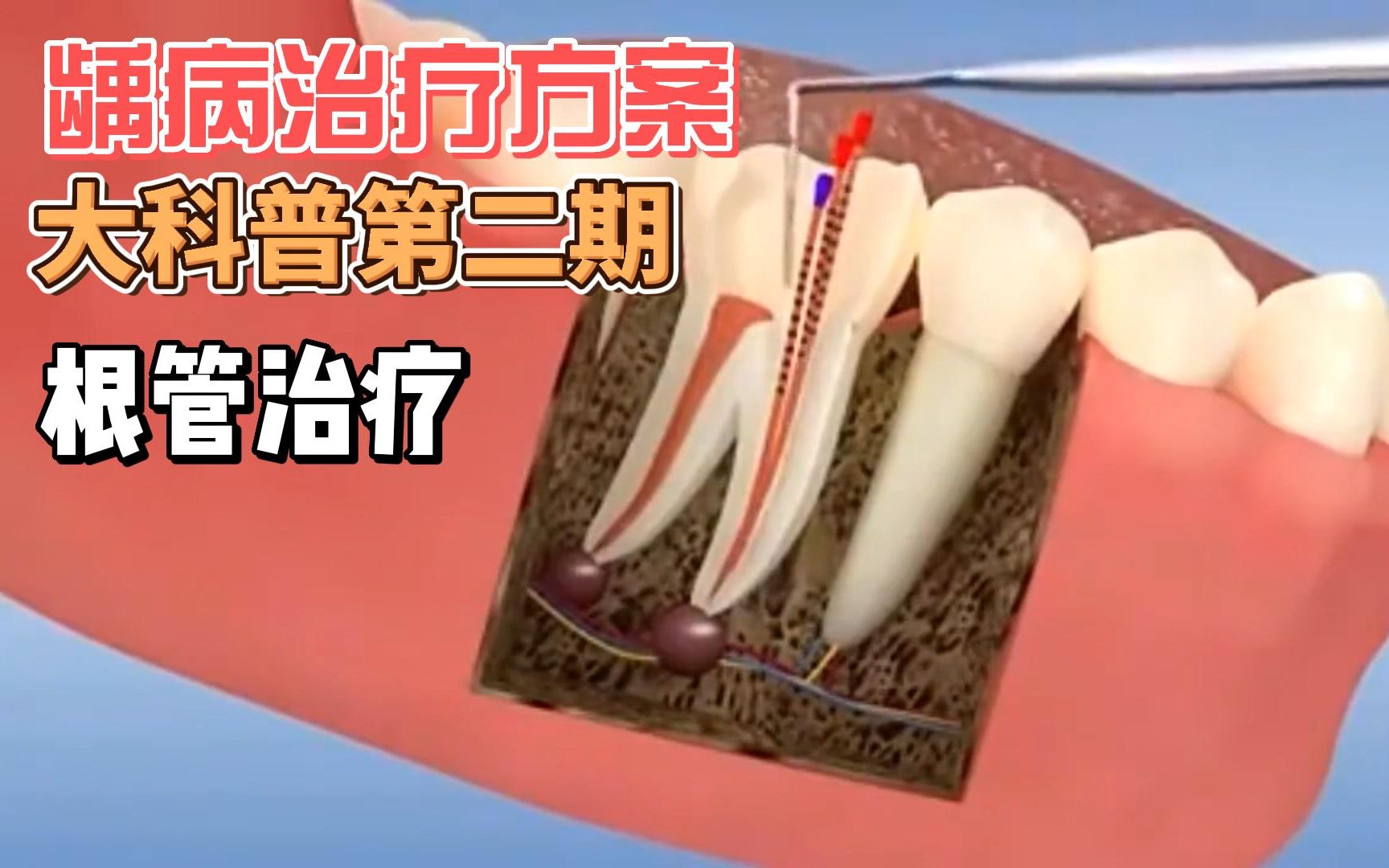 龋病治疗方案大科普第二期——根管治疗动画演示