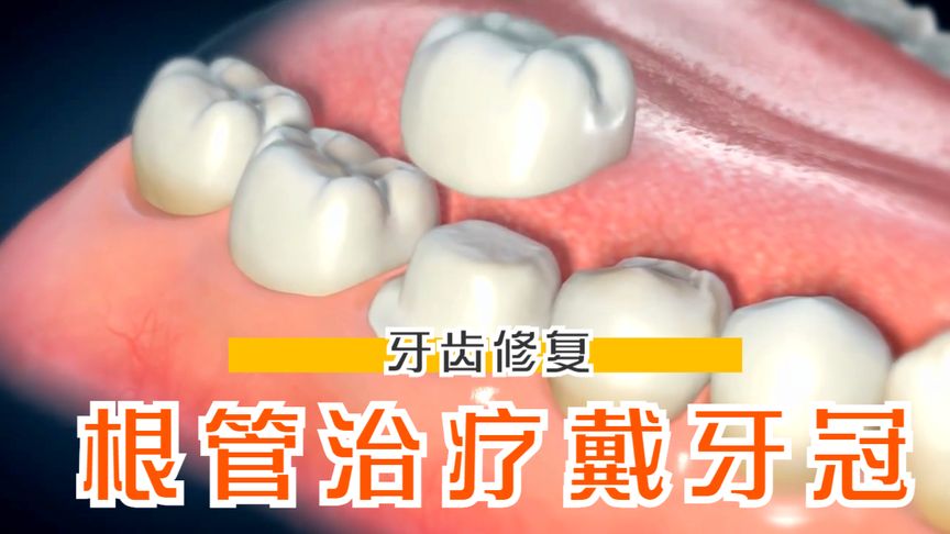 根管治疗以后一定要戴牙冠么?