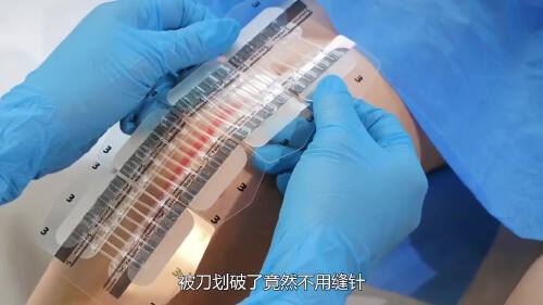 不可思议的伤闭合器像胶一样将伤粘住以此告别缝针