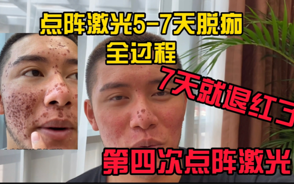 这次皮肤恢复比之前做点阵激光恢复要快很多