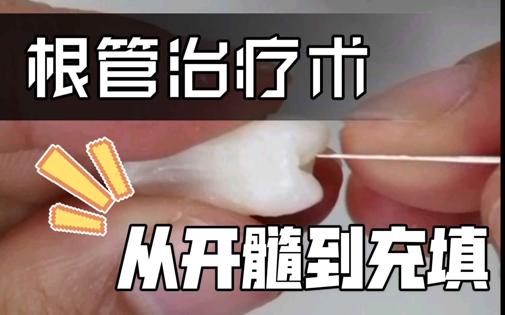 【口腔实验课】根管治疗术:从开髓到充填