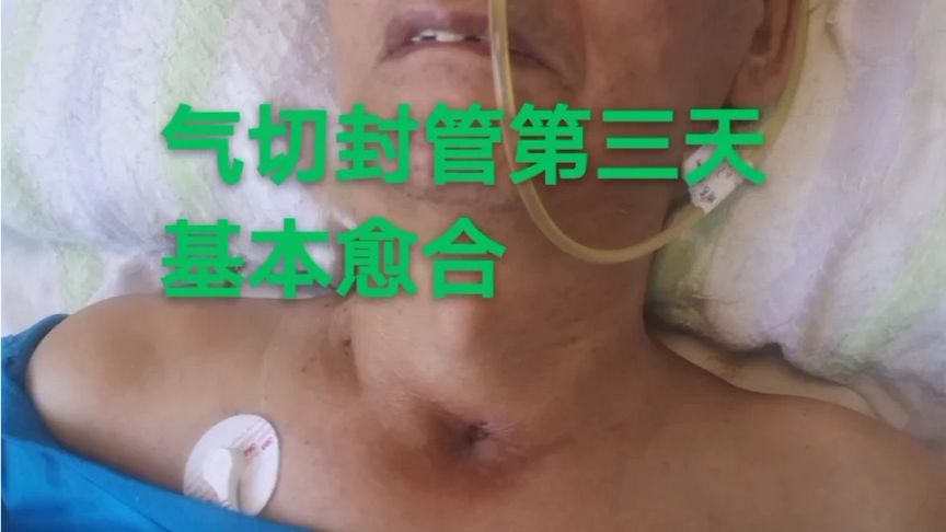 气切封管第三天,基本愈合